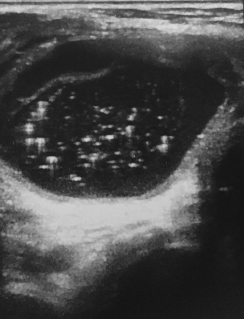 Thyroid Cysts | Dr. Francis Hall